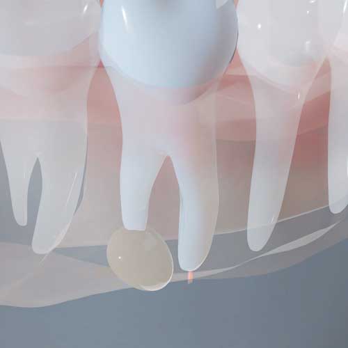 The Truth About Tooth Infections - Westpark Dental Associates